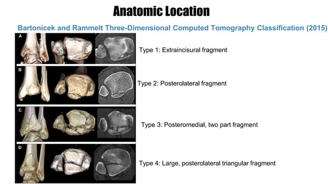 Posterior Malleolar fracture fixation | PPT