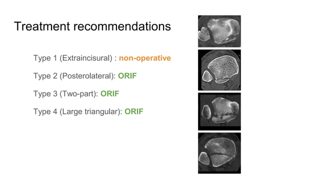 Posterior Malleolar fracture fixation | PPT