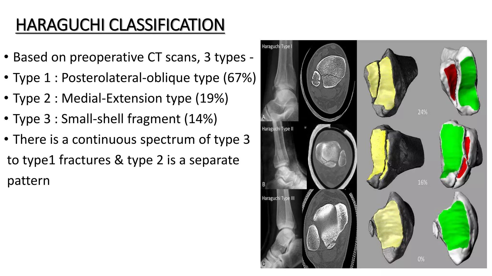 Posterior malleolus fracture | PPTX