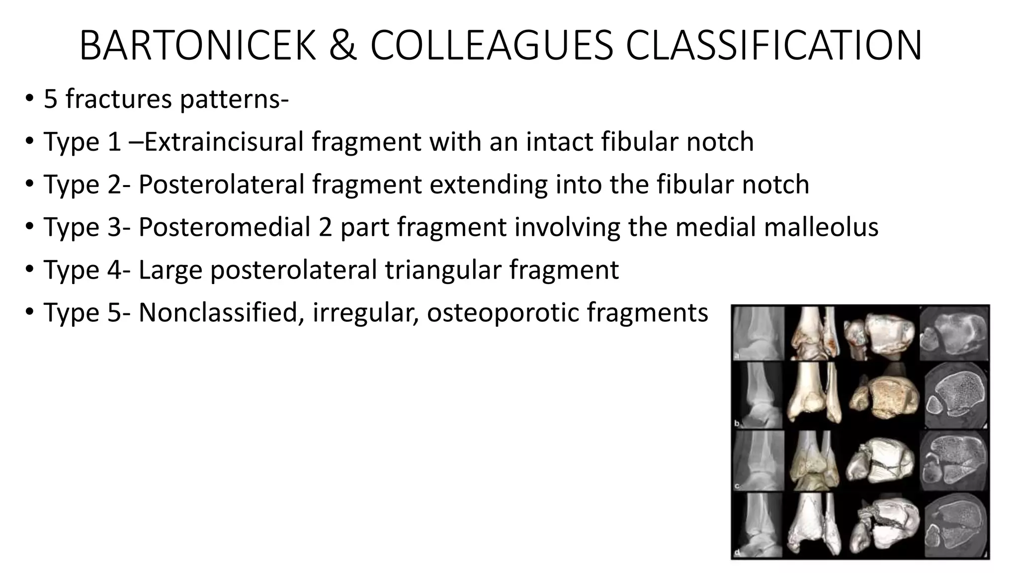 Posterior malleolus fracture | PPTX