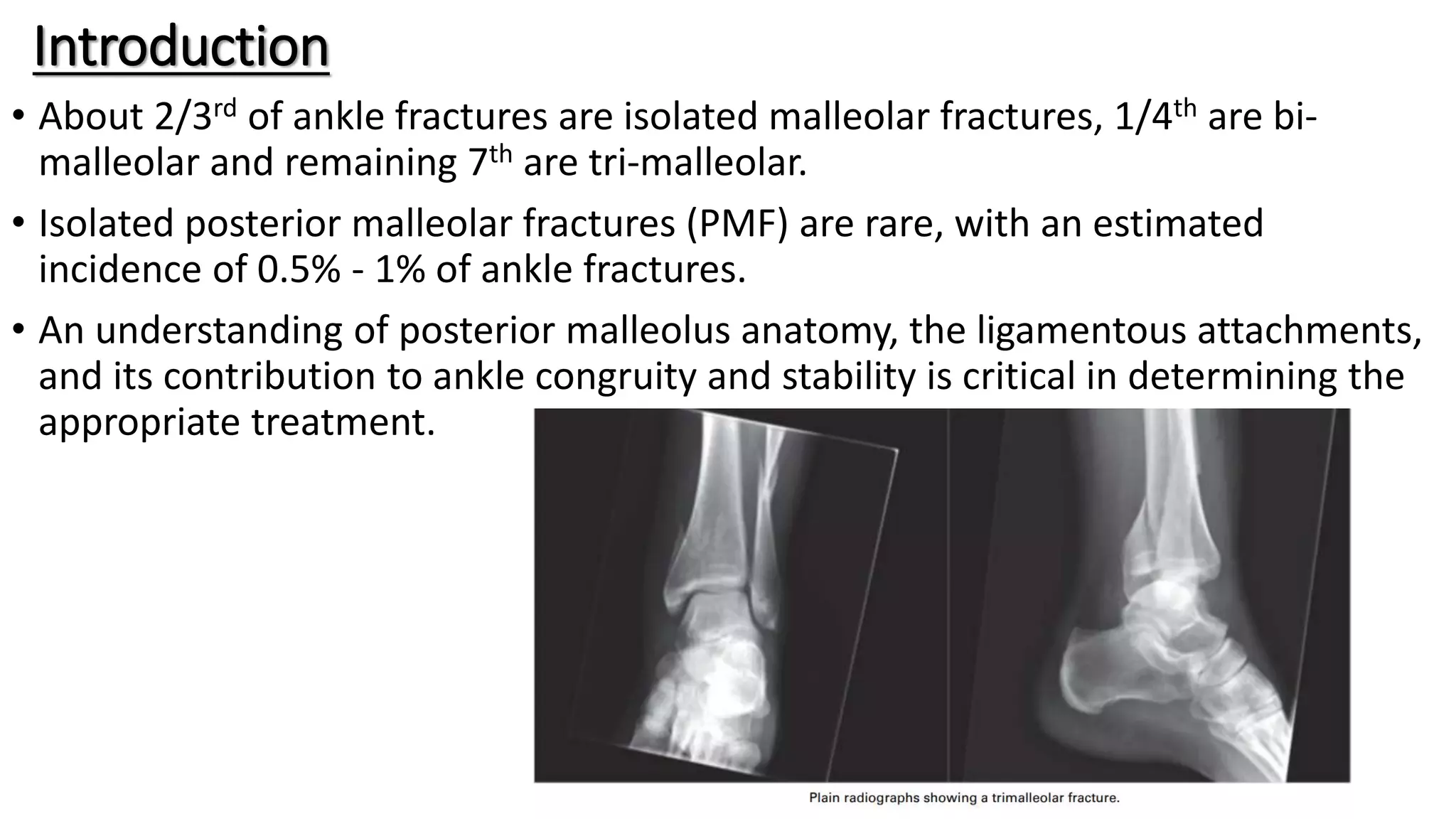 Posterior malleolus fracture | PPTX