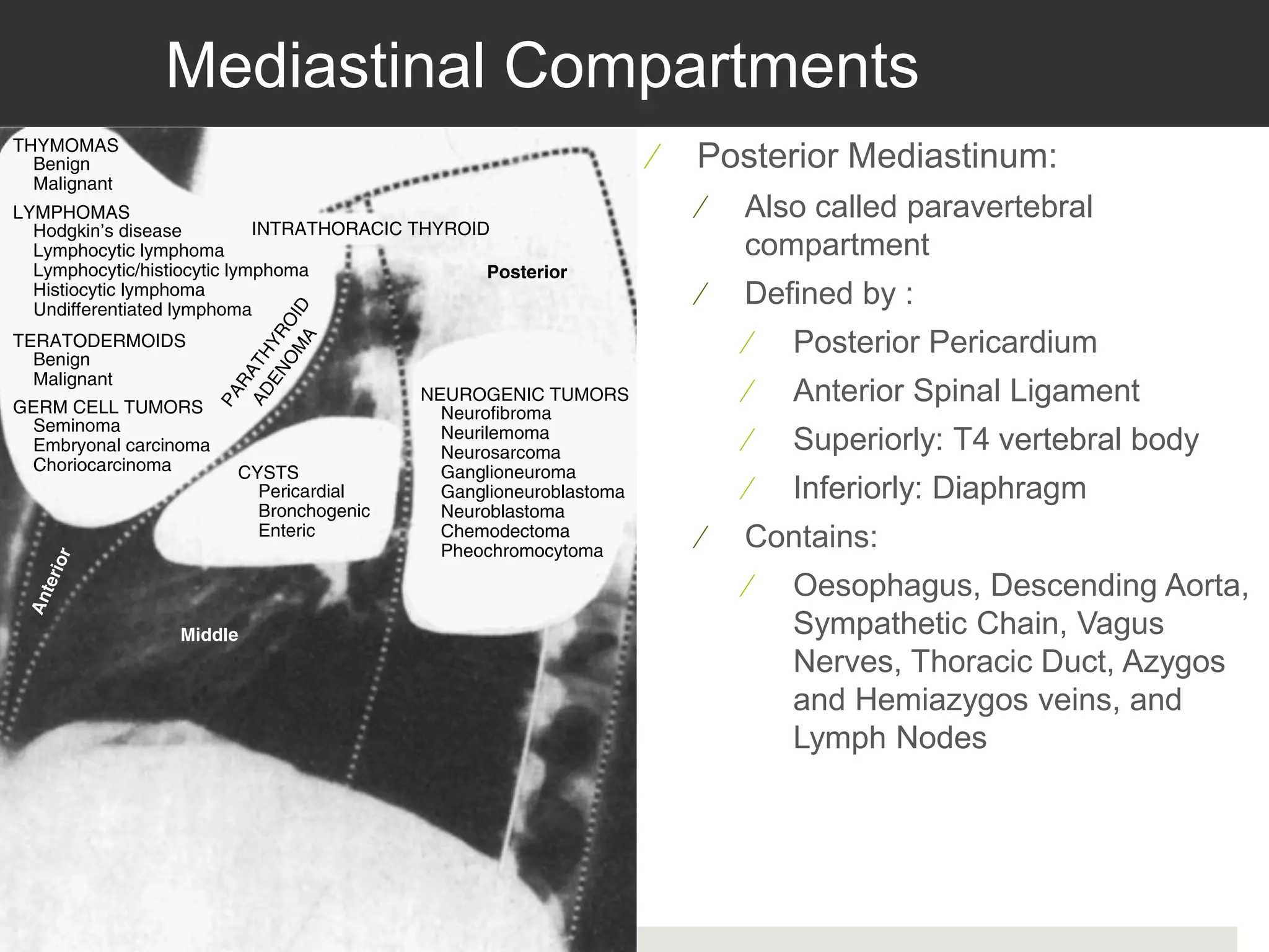 Posterior Mediastinal Lesions : A Short Review | PPTX