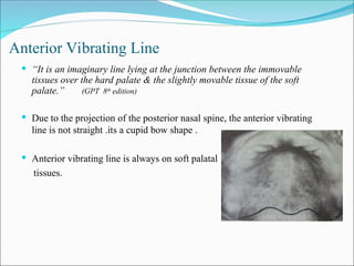 posterior palatal seal (1).ppt,,,,,,,,,,,,,,,,, | PPT