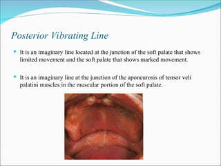 posterior palatal seal (1).ppt,,,,,,,,,,,,,,,,, | PPT