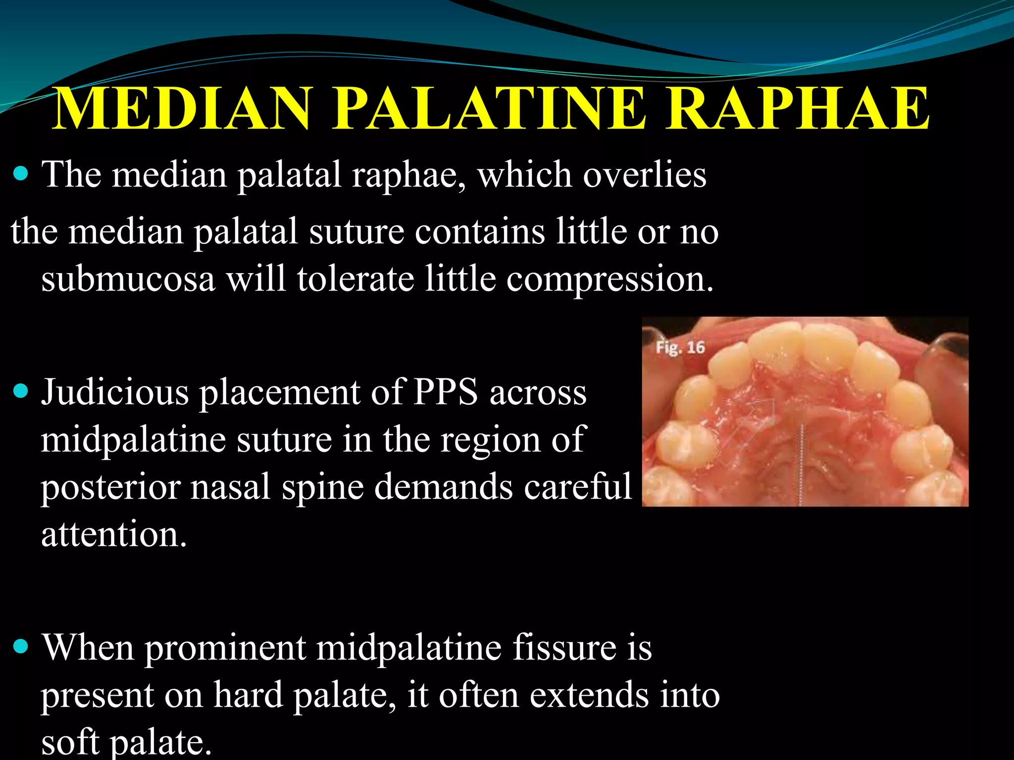 Posterior Palatal Seal_113550.pptx