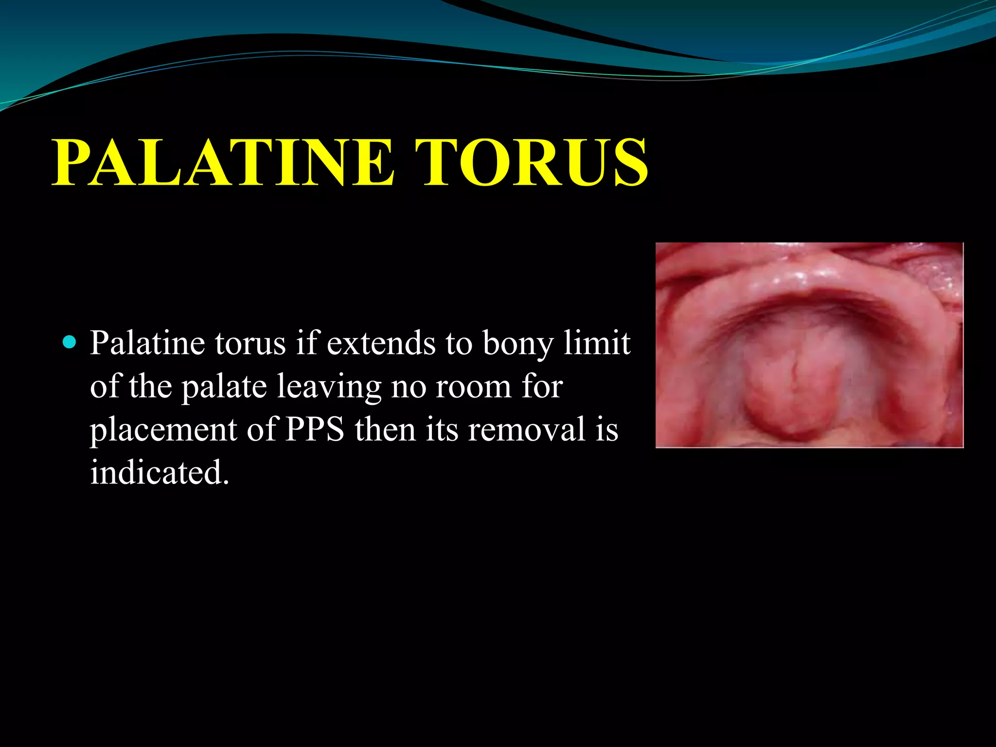 Posterior Palatal Seal_113550.pptx