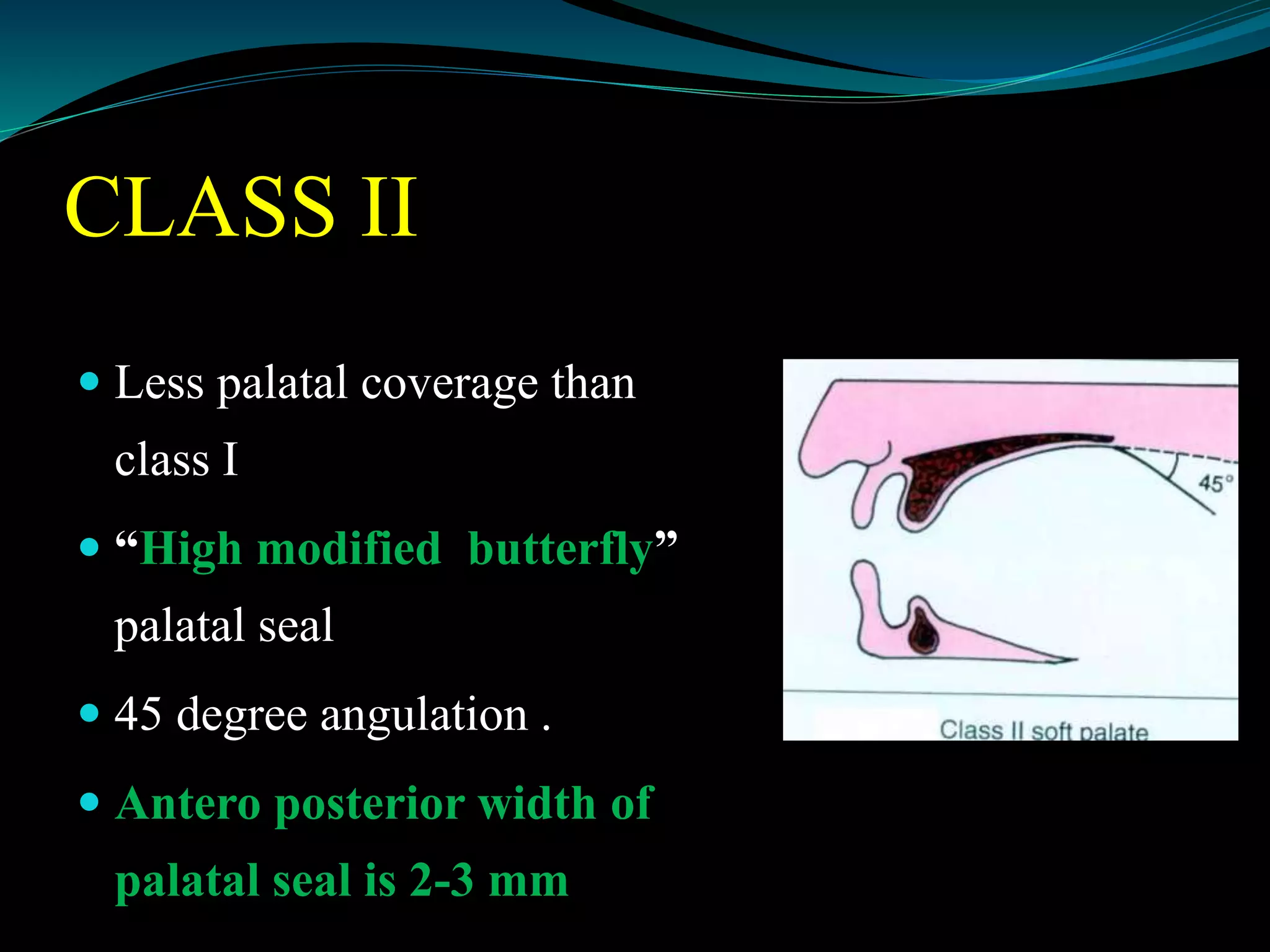 Posterior Palatal Seal_113550.pptx