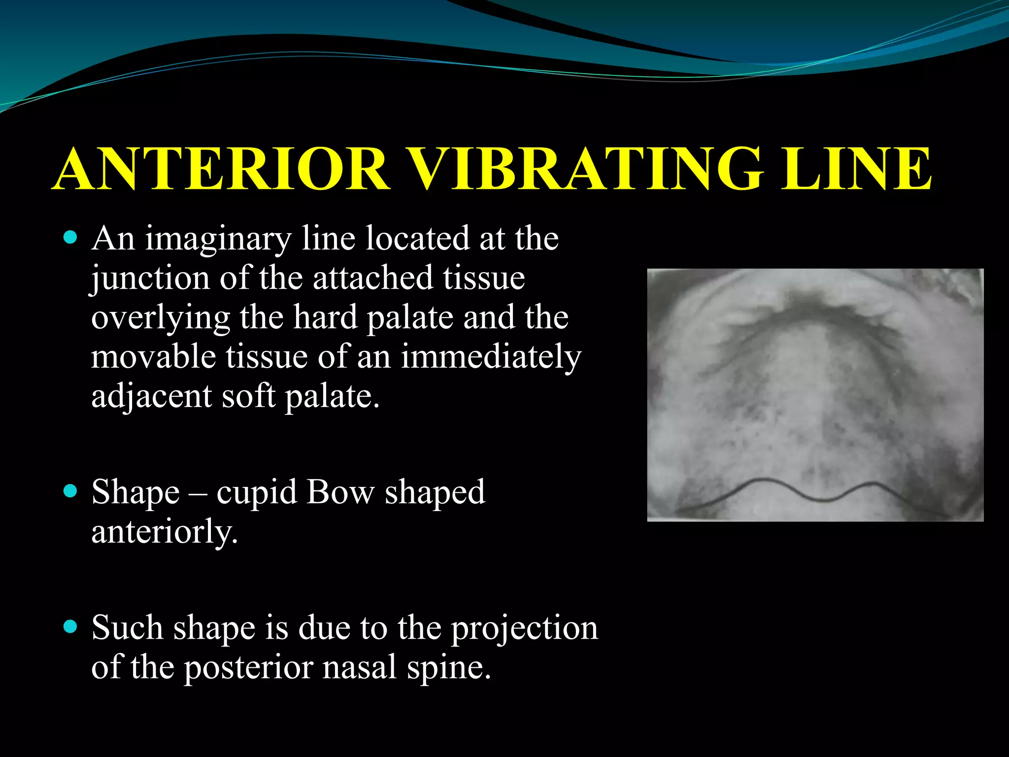 Posterior Palatal Seal_113550.pptx