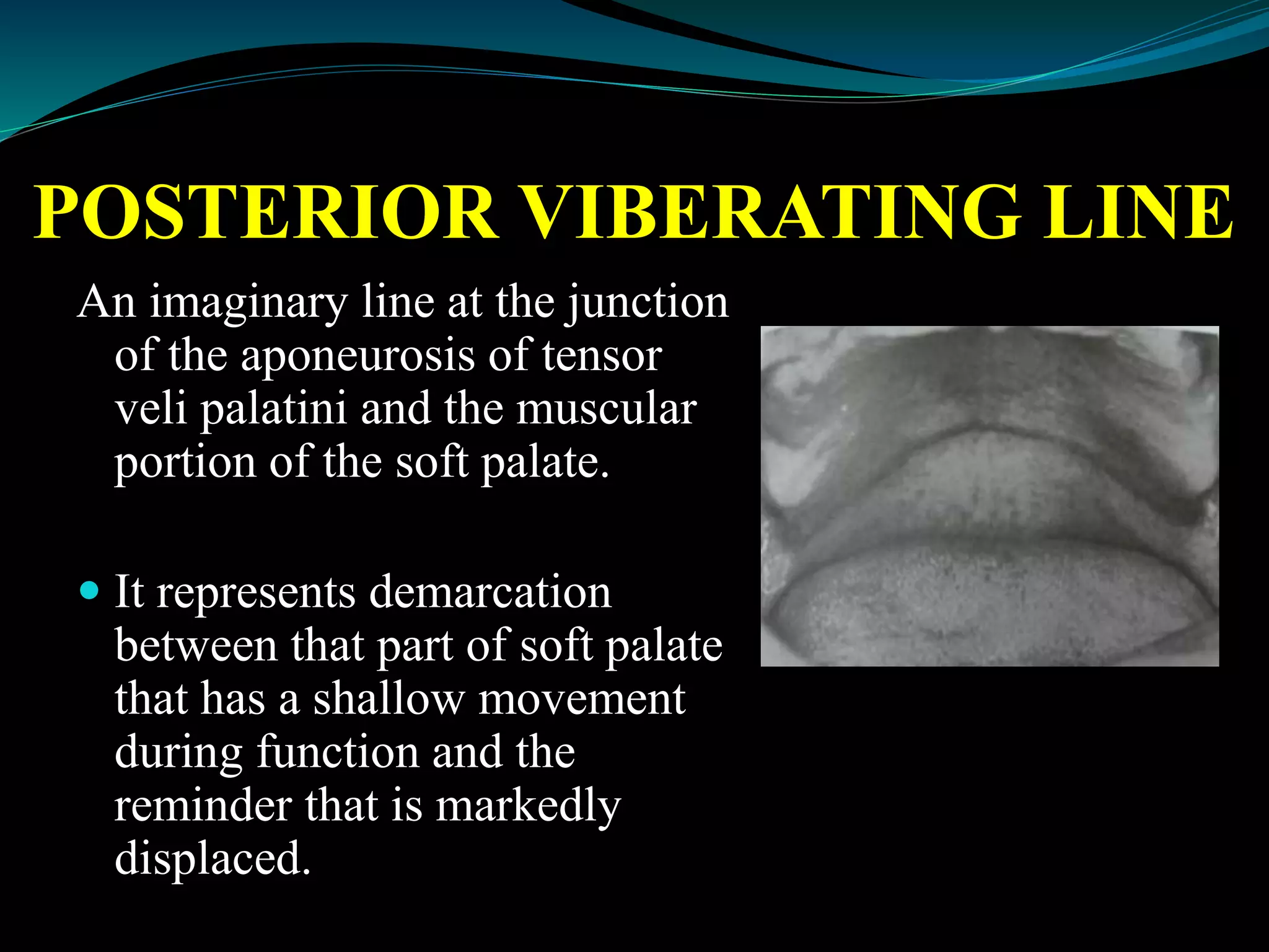 Posterior Palatal Seal_113550.pptx