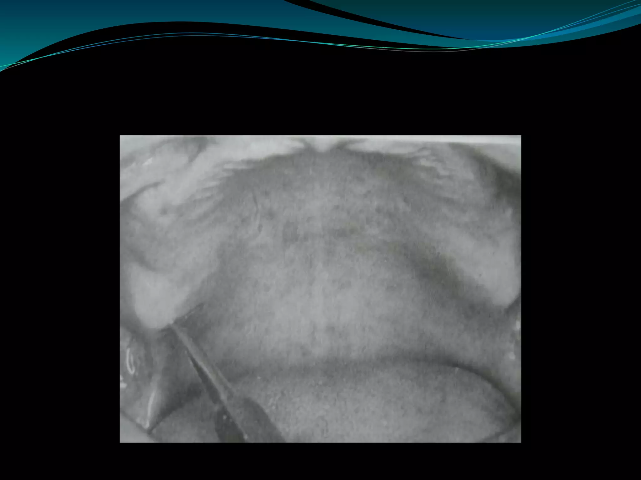 Posterior Palatal Seal_113550.pptx
