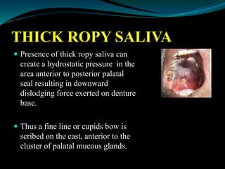 Posterior Palatal Seal_113550.pptx