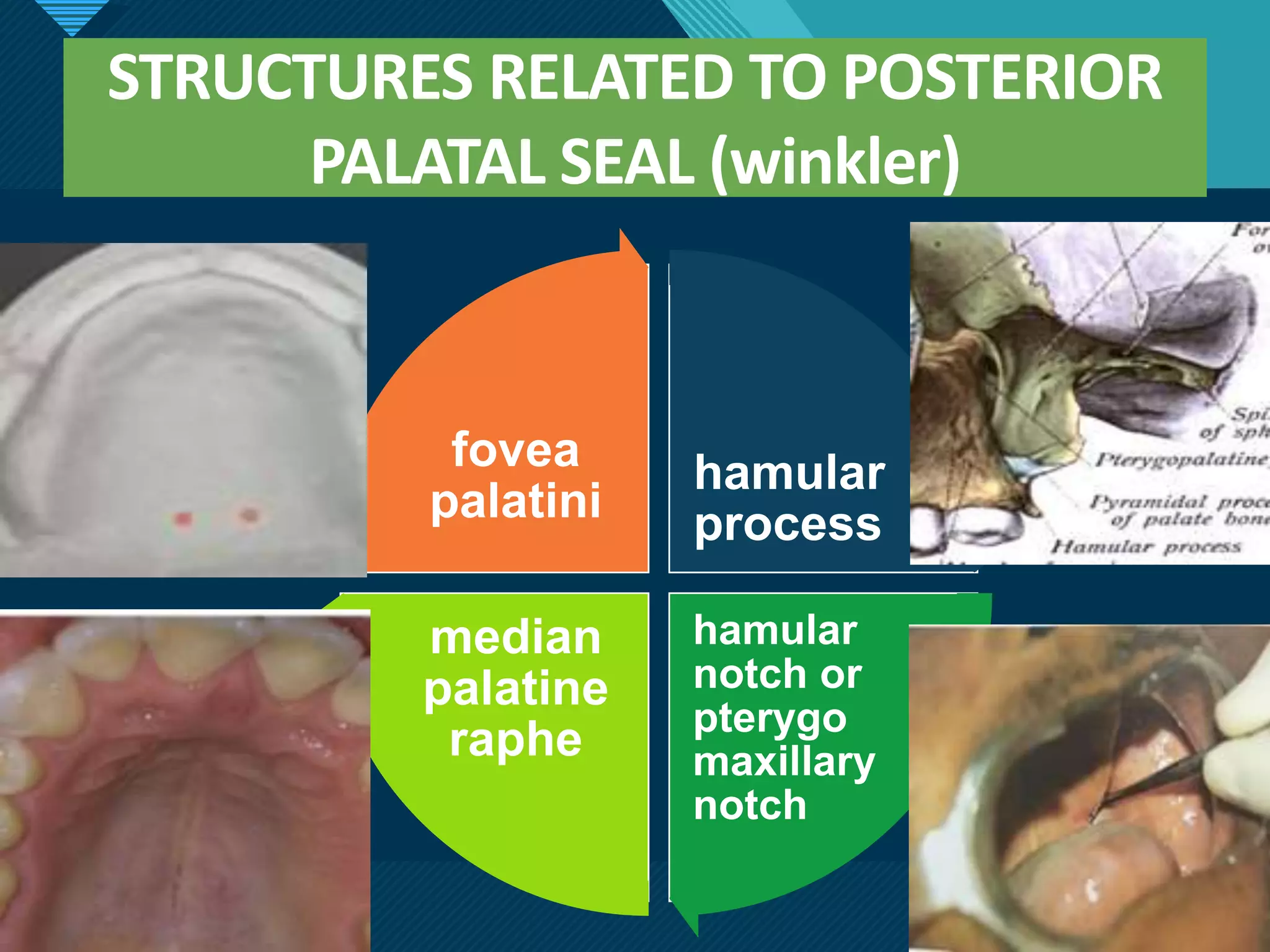 Posterior palatal seal | PPT