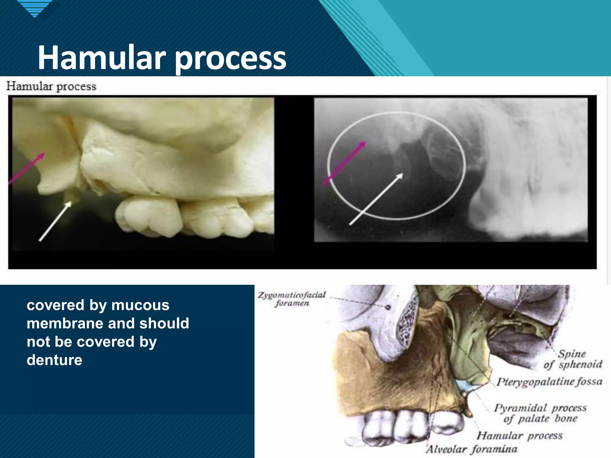 Posterior palatal seal | PPT