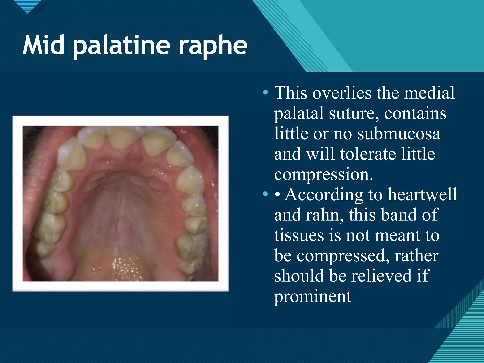 Posterior palatal seal | PPT