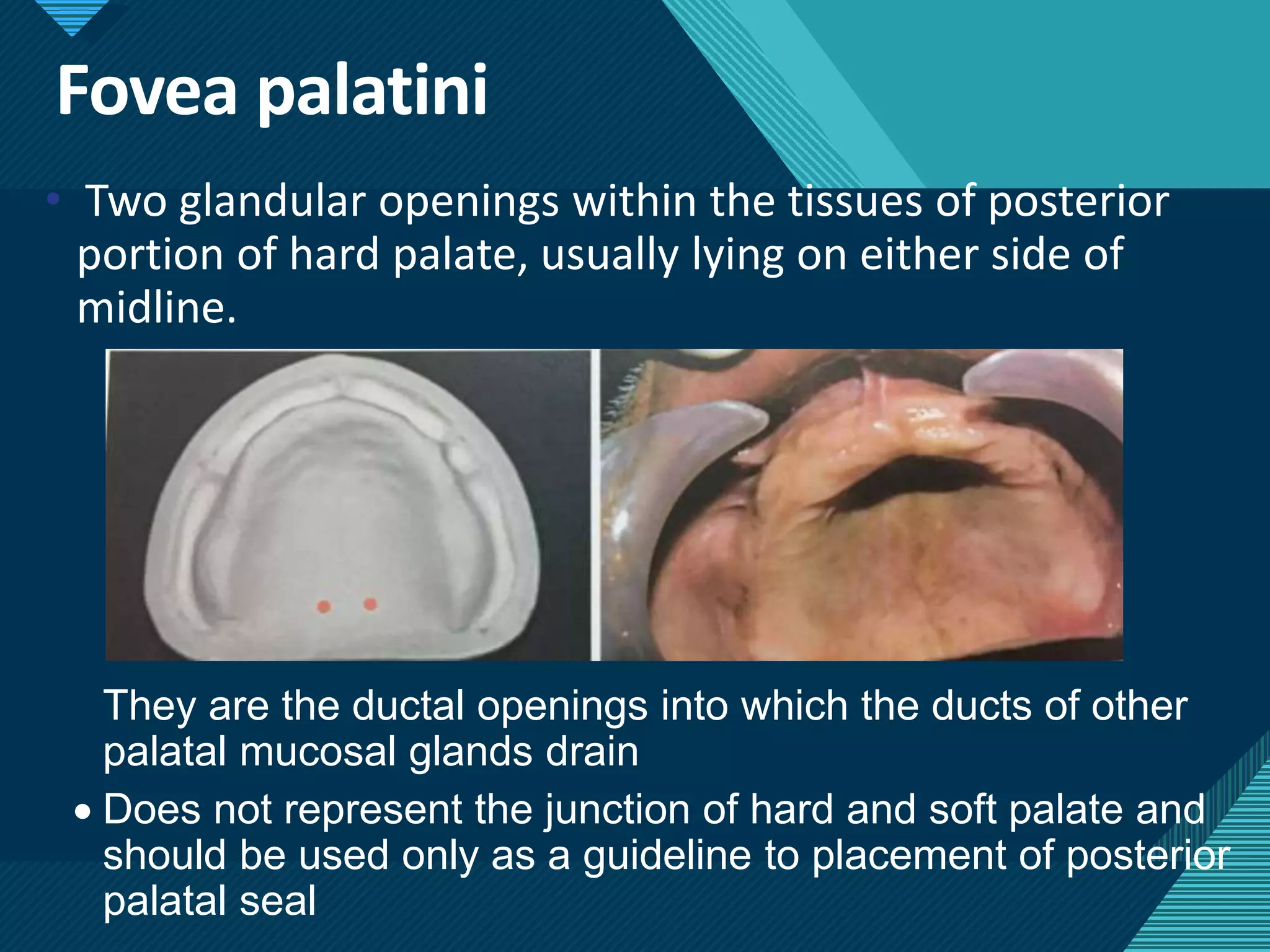 Posterior palatal seal | PPT