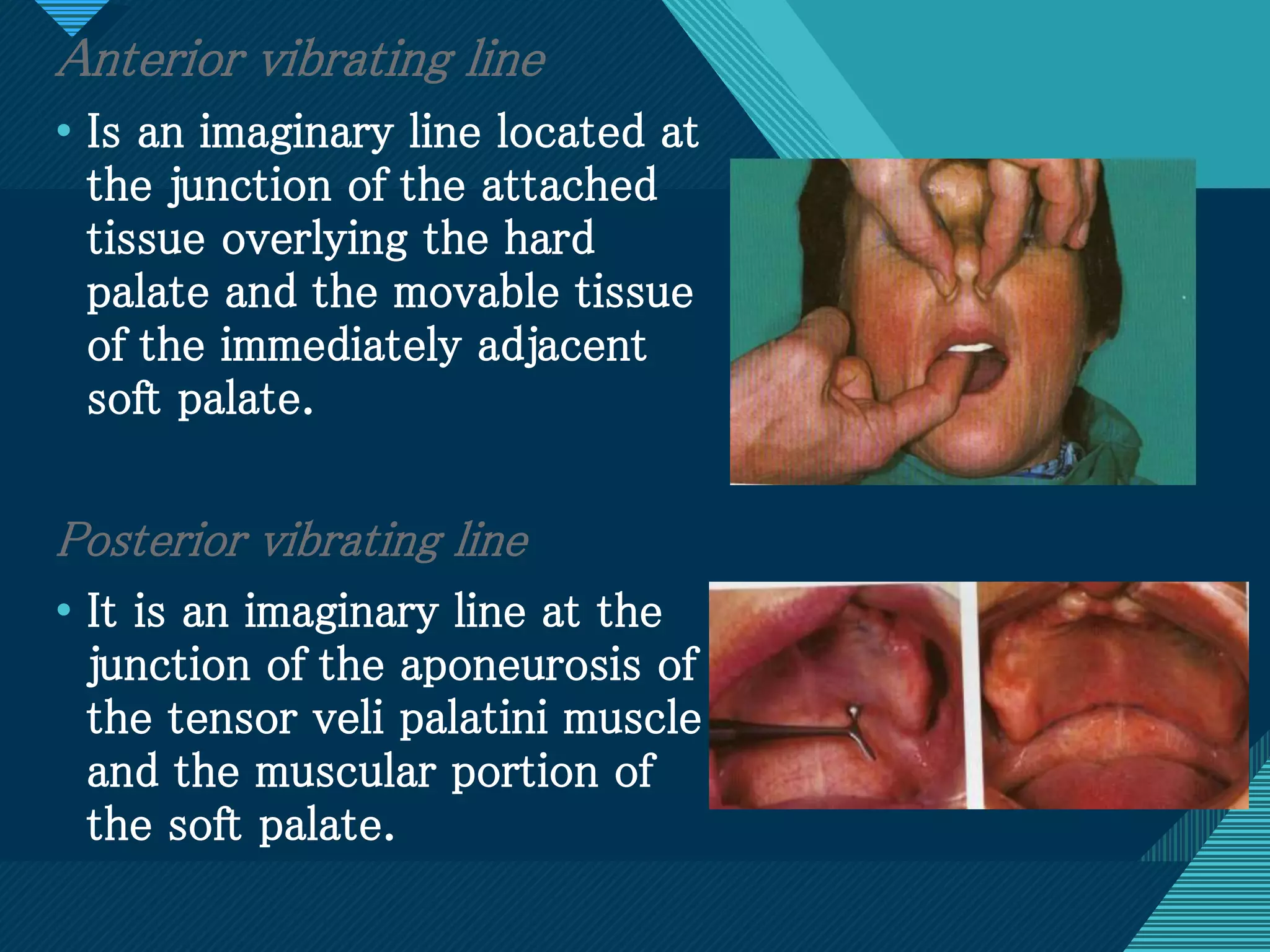 Posterior palatal seal | PPT