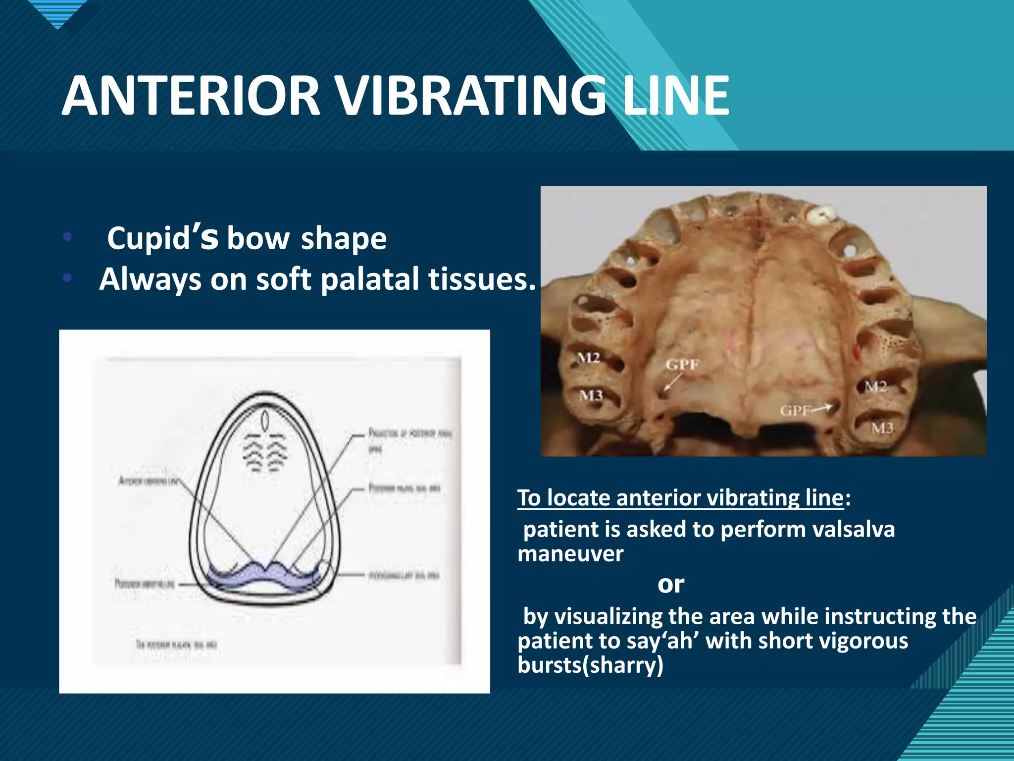 Posterior palatal seal | PPT