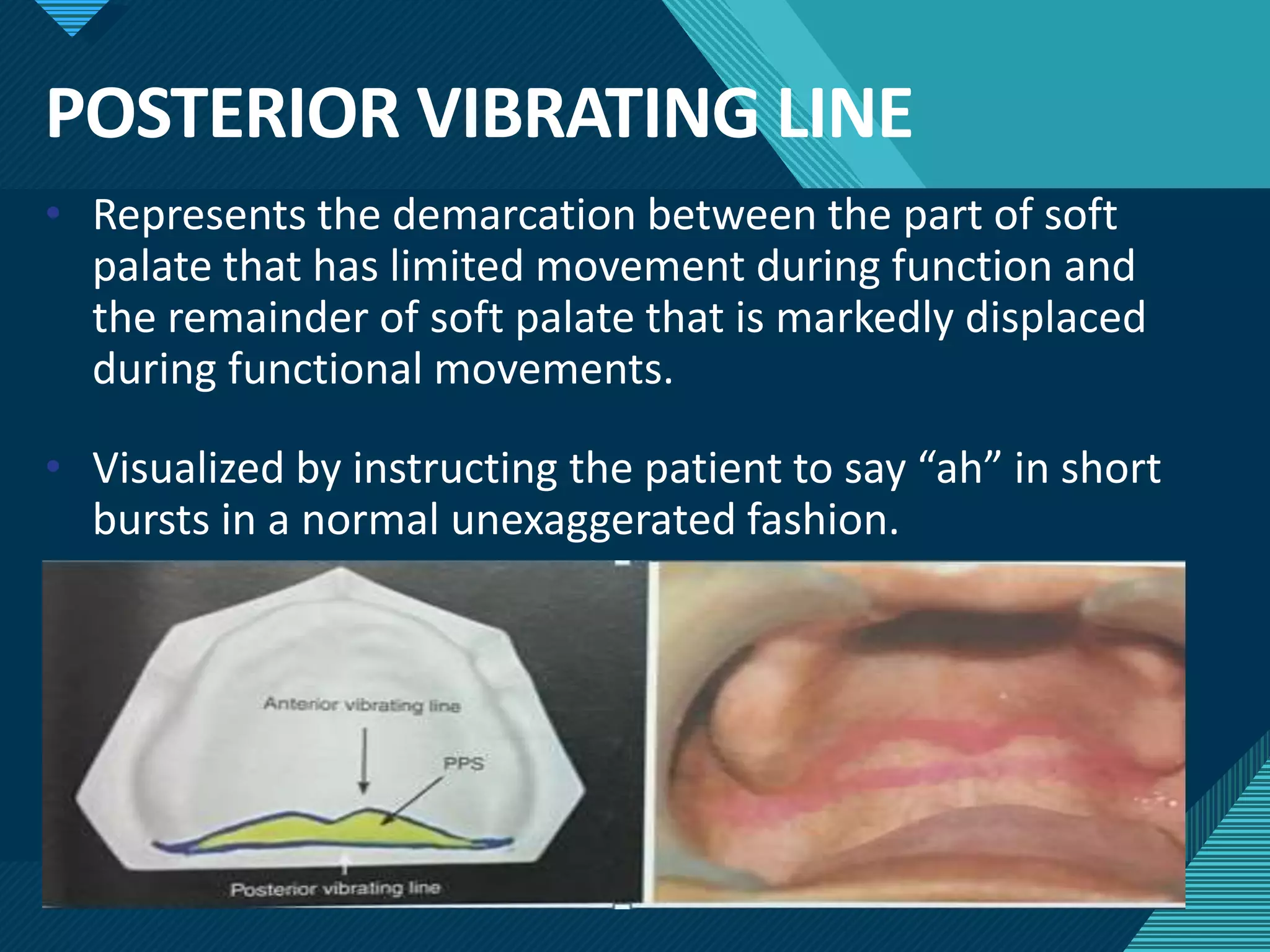 Posterior palatal seal | PPT