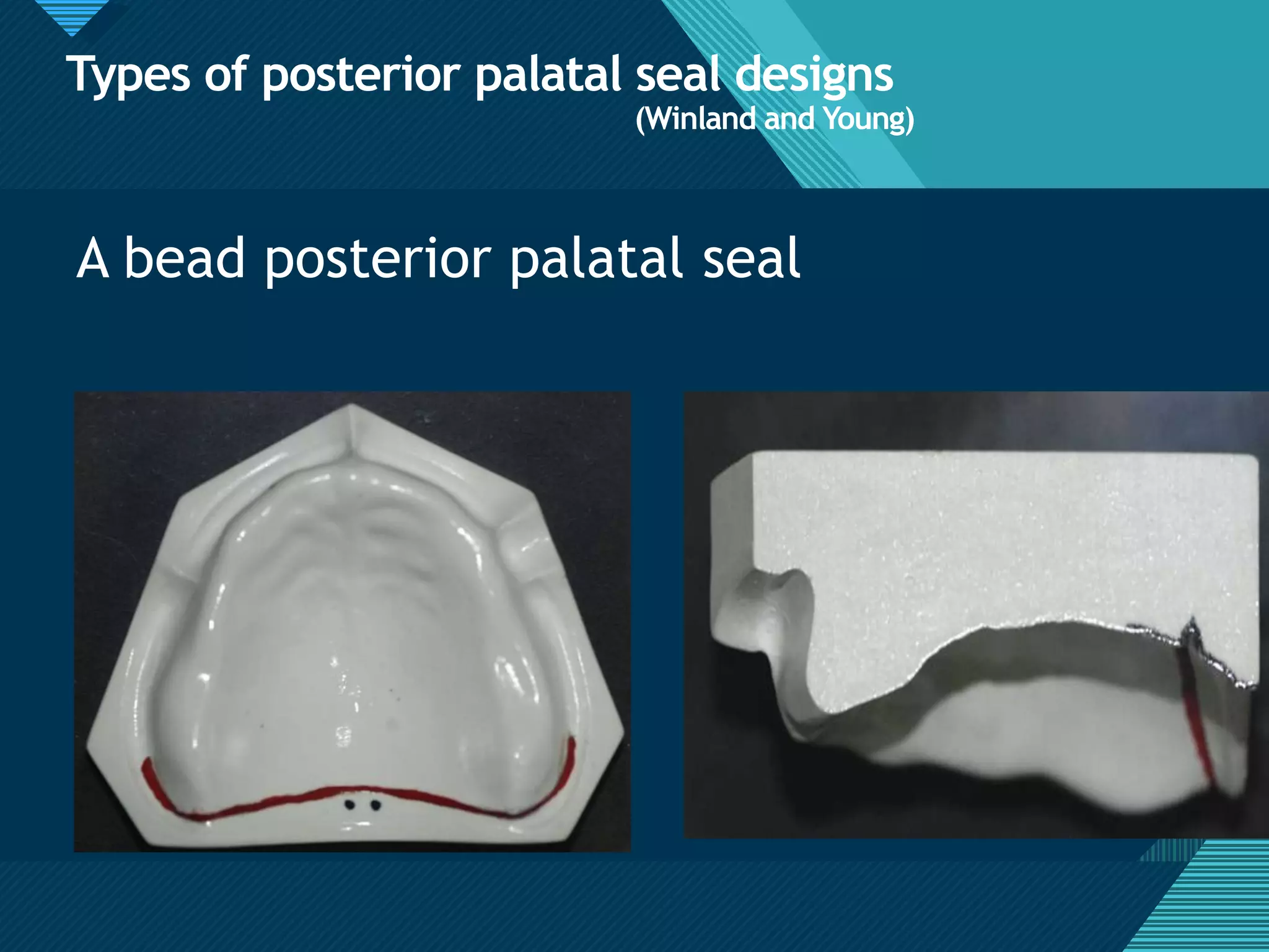 Posterior palatal seal | PPT