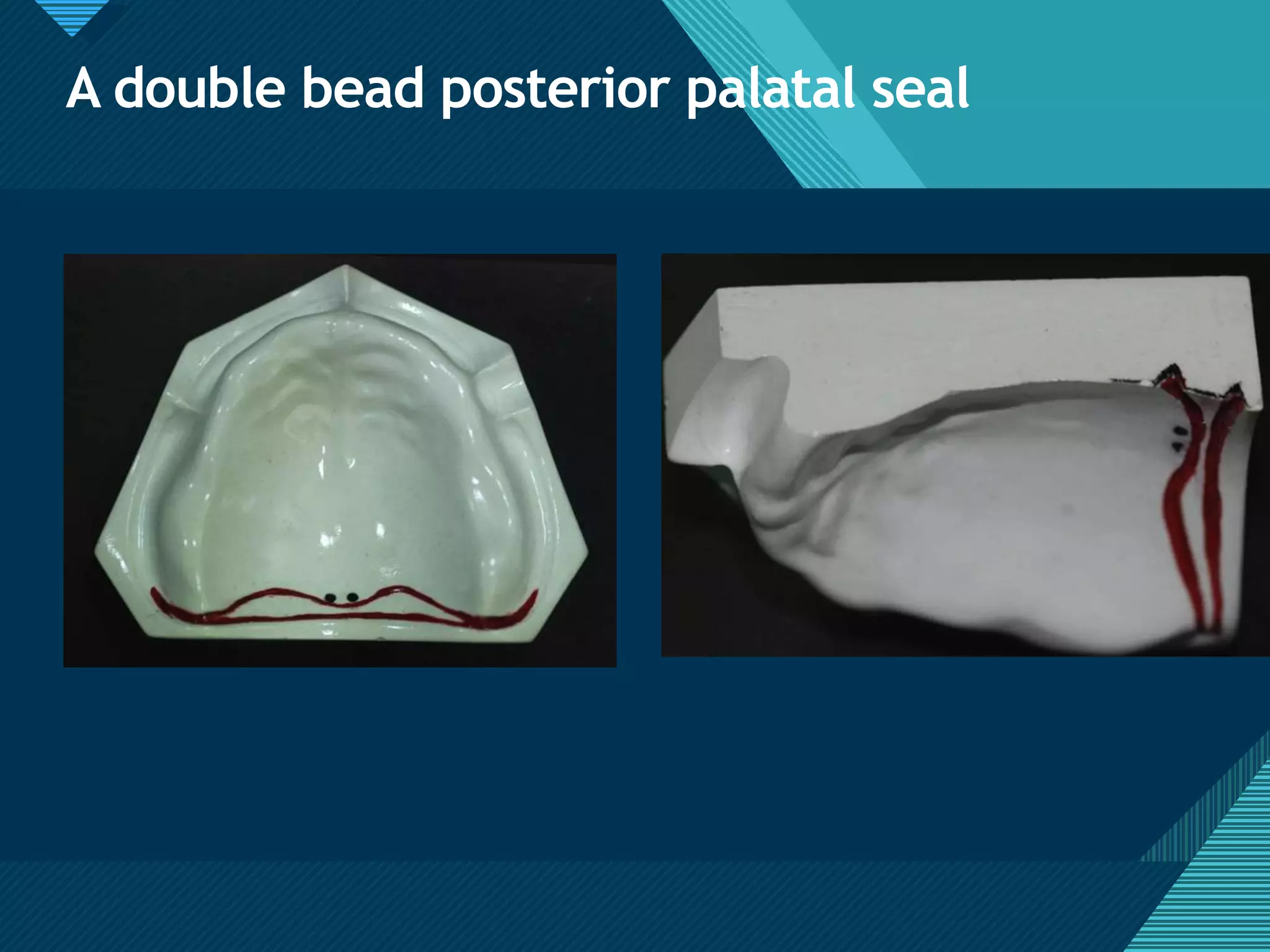 Posterior palatal seal | PPT