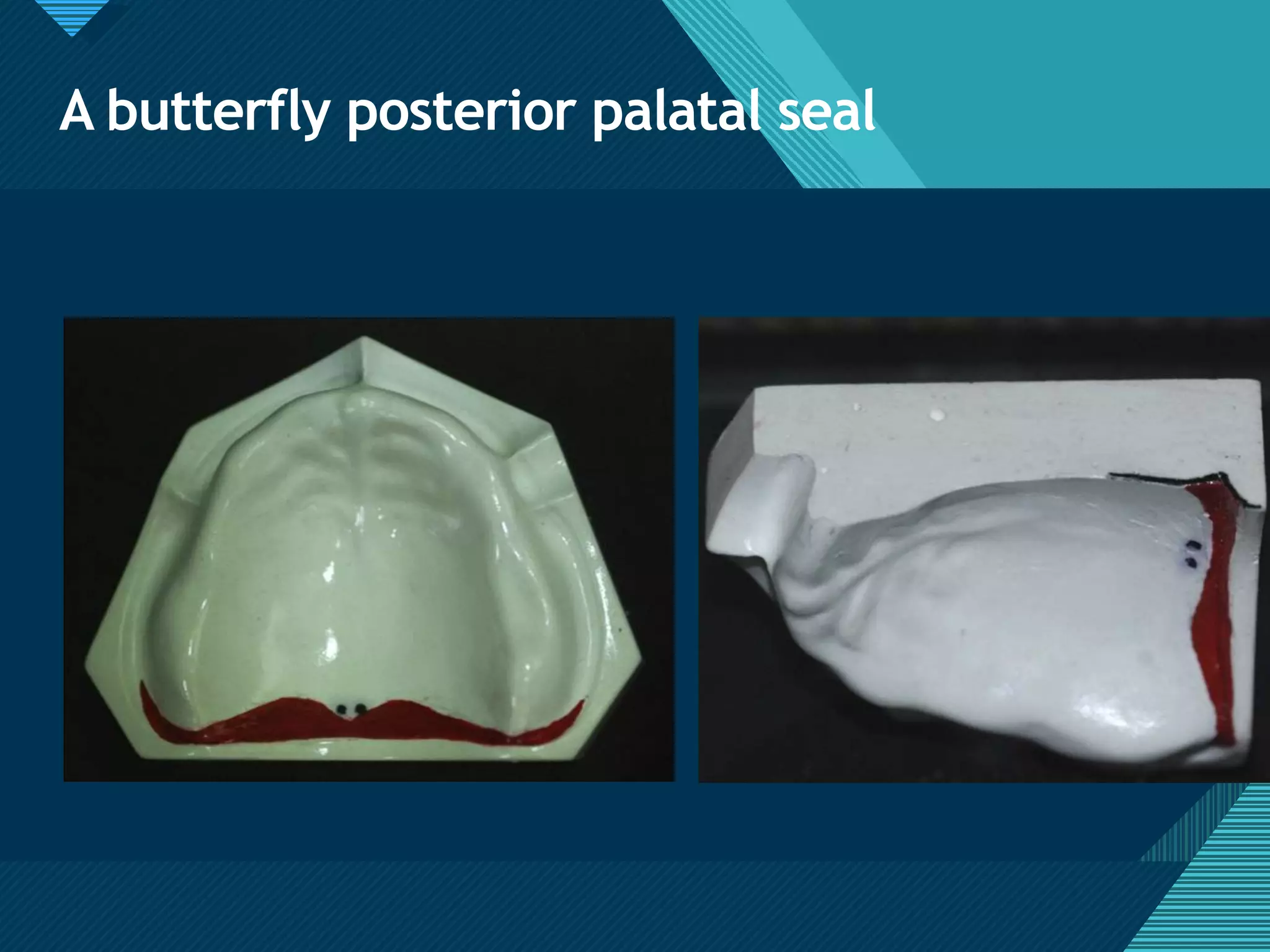 Posterior palatal seal | PPT
