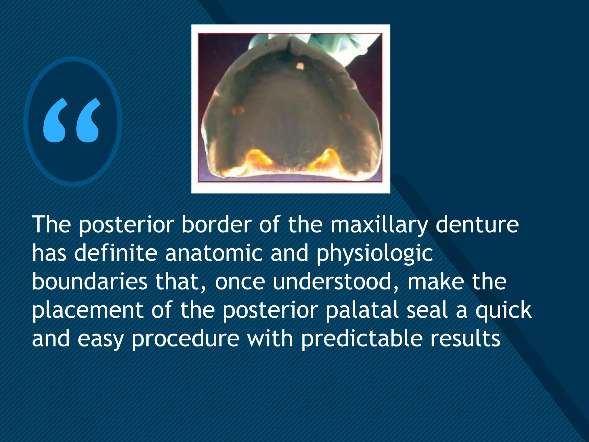 Posterior palatal seal | PPT