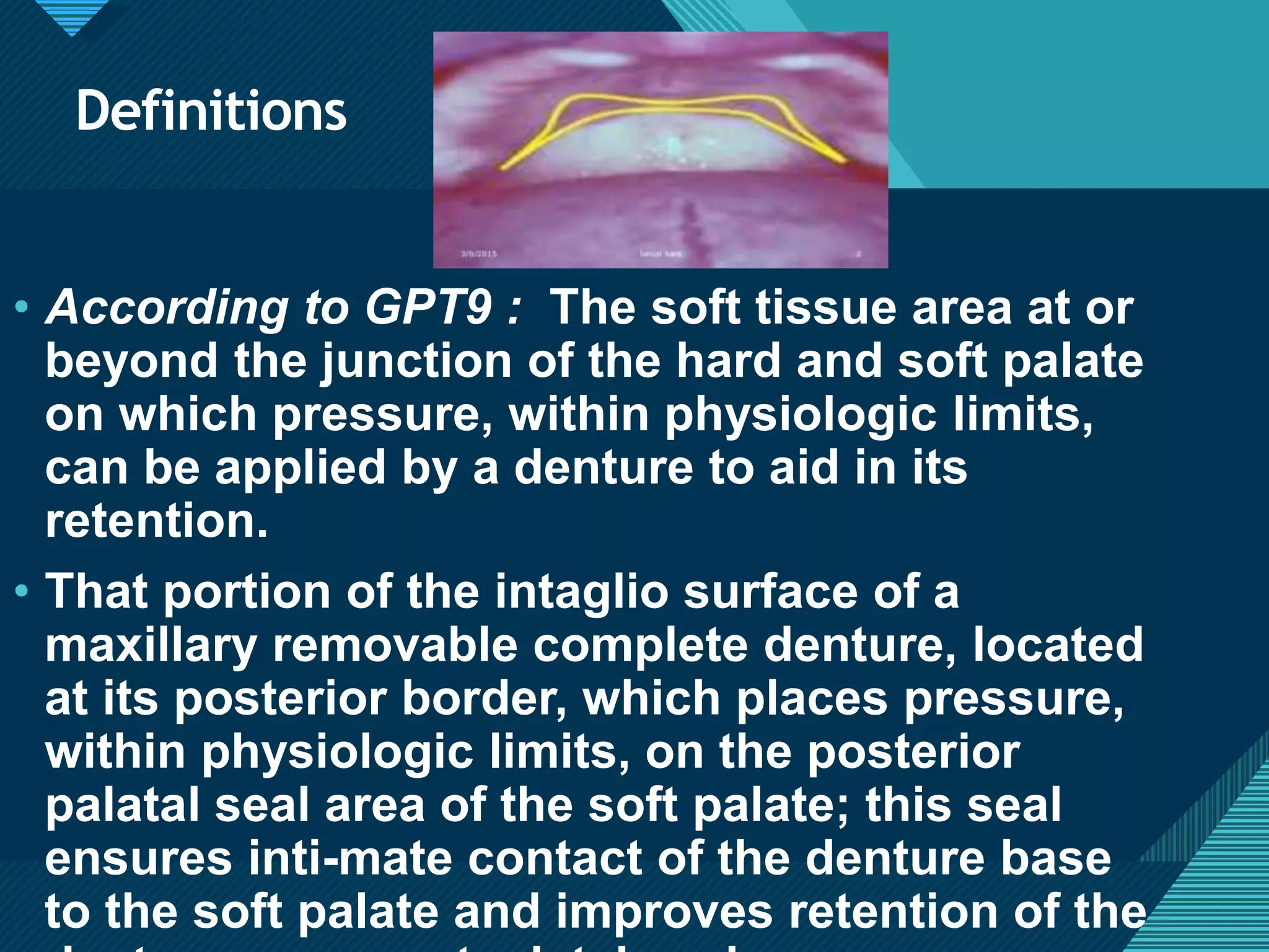 Posterior palatal seal | PPT