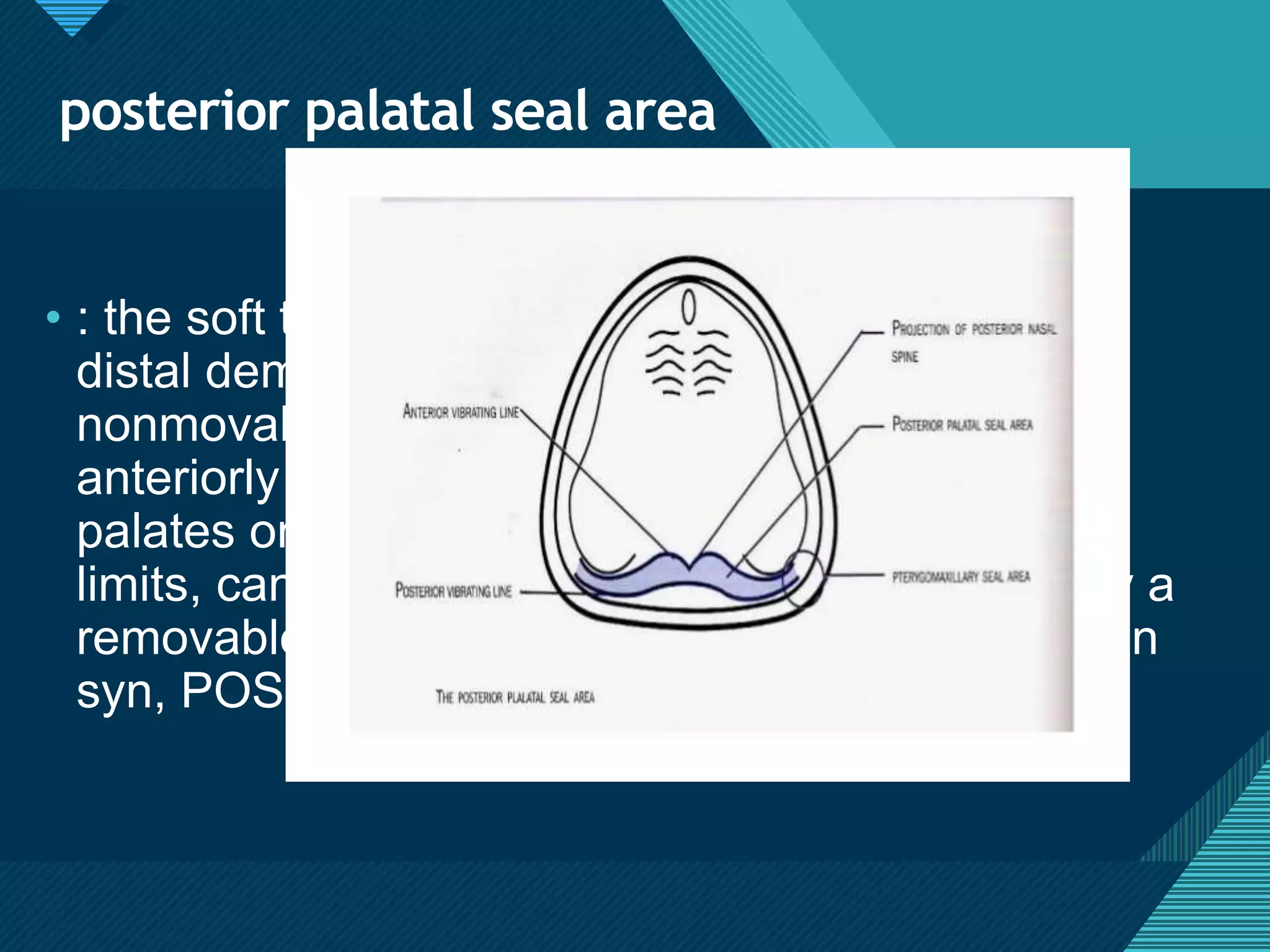Posterior palatal seal | PPT