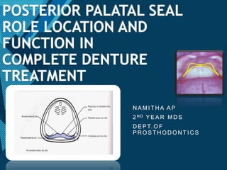 Posterior Palatal Seal In Complete Denture