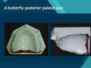 Posterior palatal seal | PPT