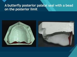 Posterior palatal seal | PPT