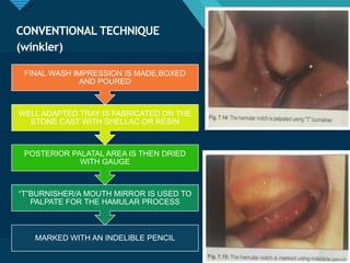 Posterior palatal seal | PPT