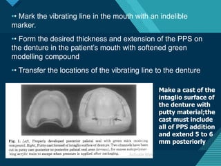 Posterior palatal seal | PPT