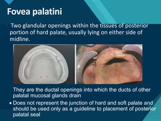 Fovea Palatini Vibrating Line