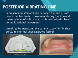 Vibrating Line