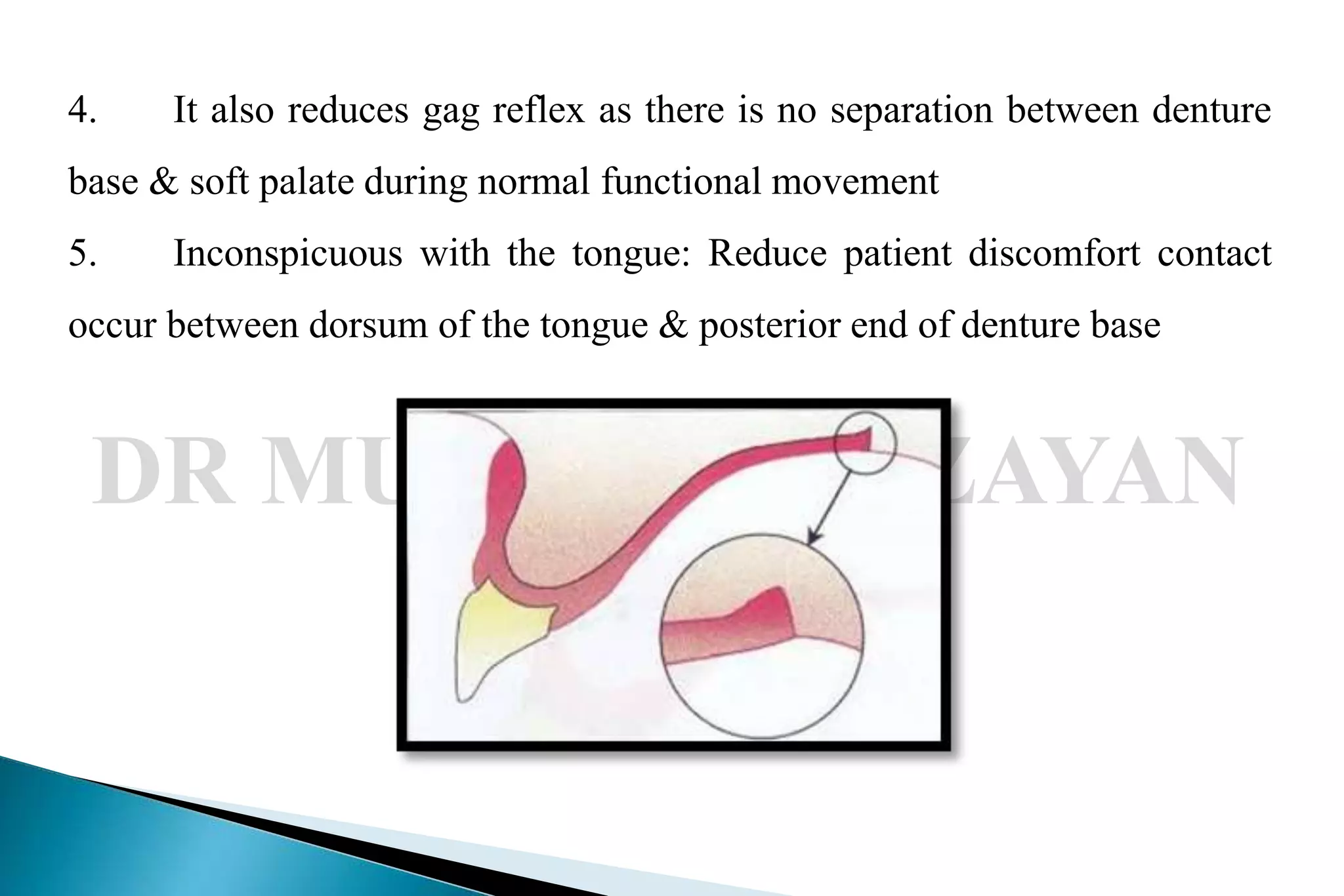 Posterior palatal seal 2nd yr | PPTX