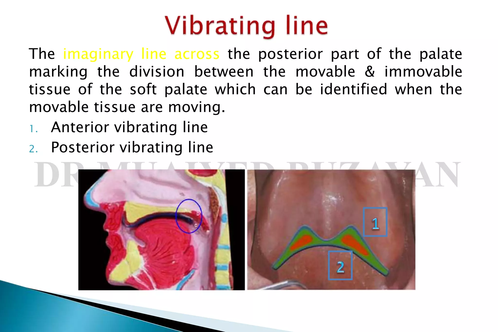 Posterior palatal seal 2nd yr | PPTX