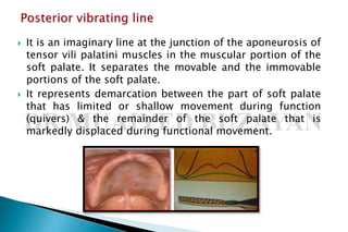 Posterior palatal seal 2nd yr | PPTX
