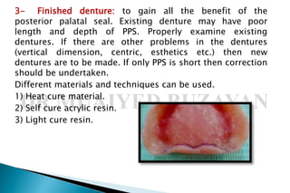 Posterior palatal seal 2nd yr | PPTX
