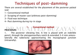 Posterior palatal seal 2nd yr | PPTX