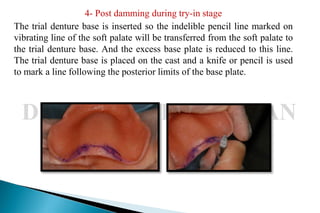 Posterior palatal seal 2nd yr | PPTX
