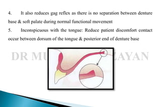 Posterior palatal seal 2nd yr | PPTX