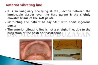 Vibrating Line Of Palate