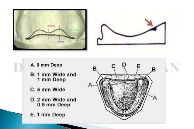Posterior palatal seal 2nd yr