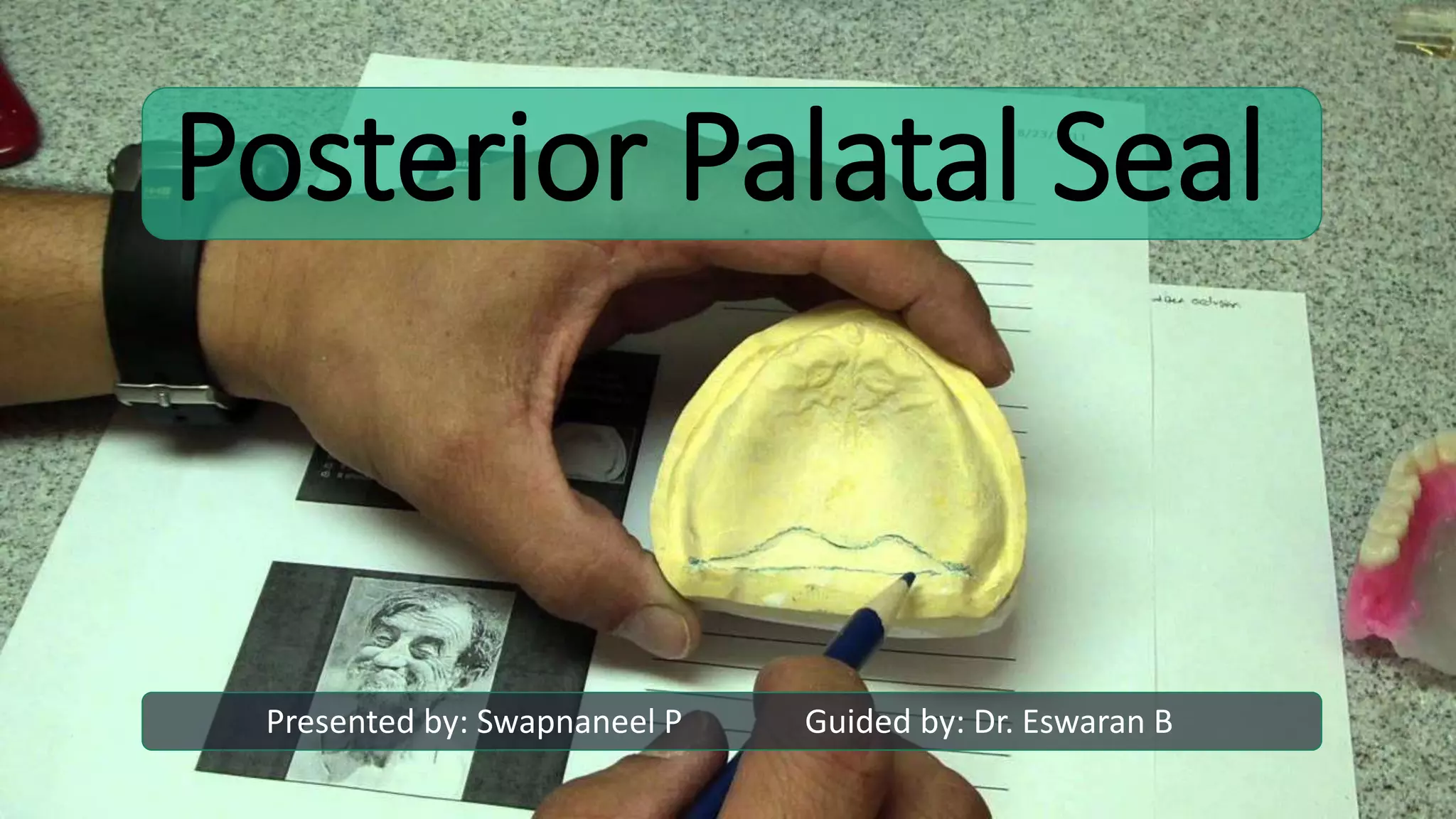 Posterior Palatal Seal | PPTX
