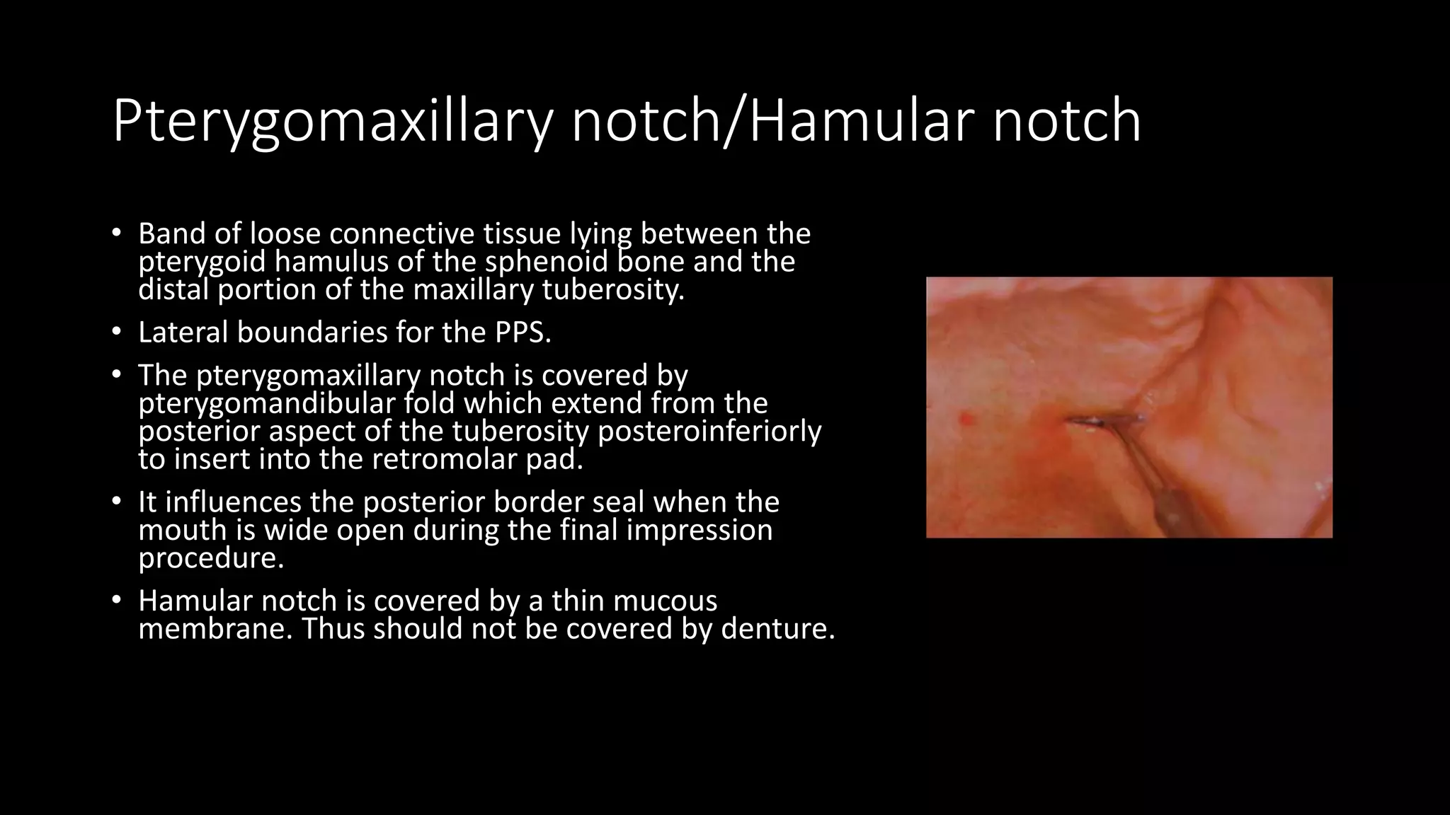 Posterior Palatal Seal | PPTX
