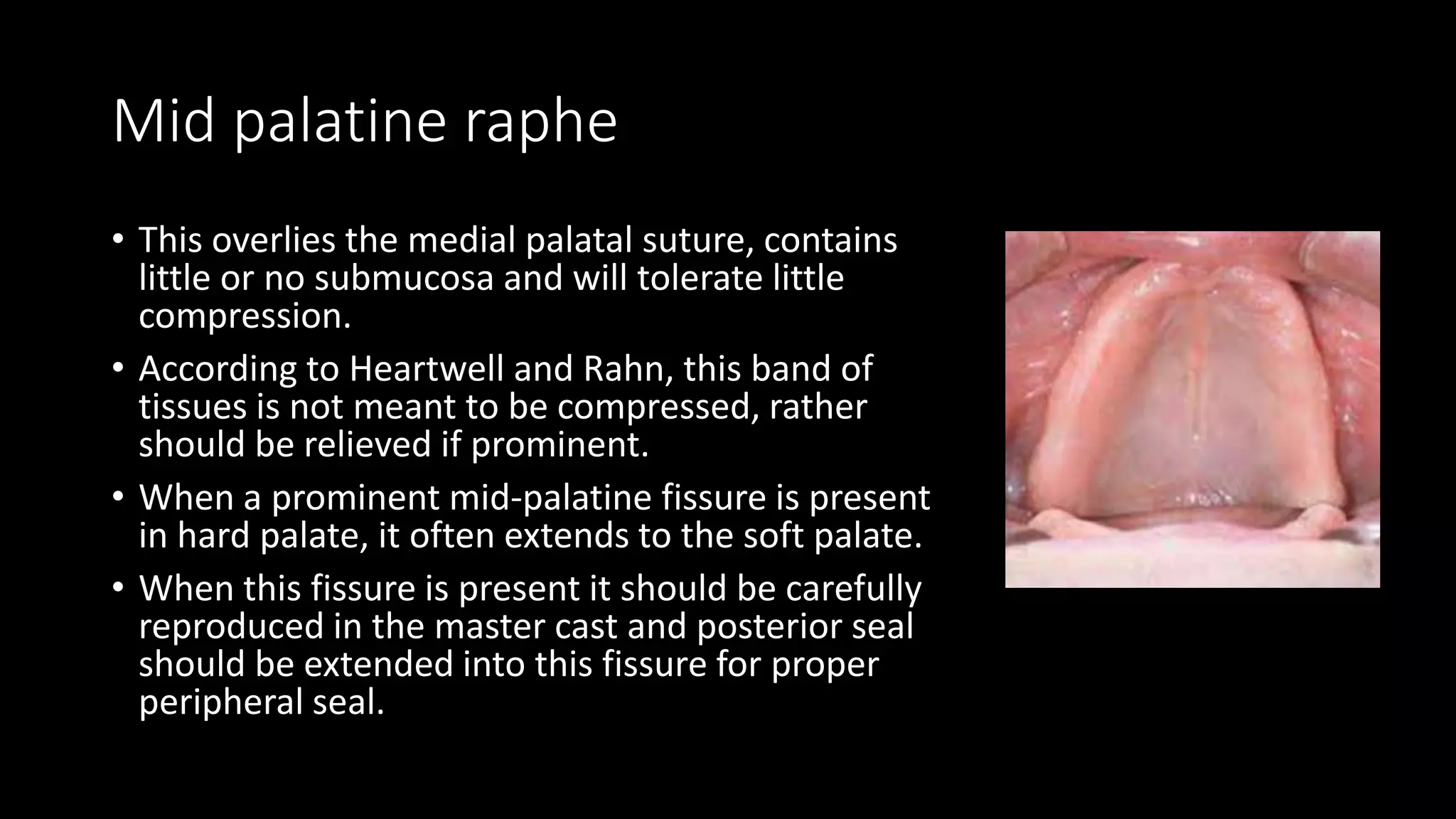 Posterior Palatal Seal | PPTX