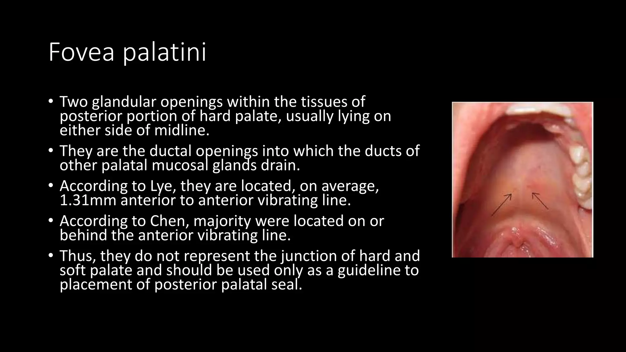 Posterior Palatal Seal | PPTX