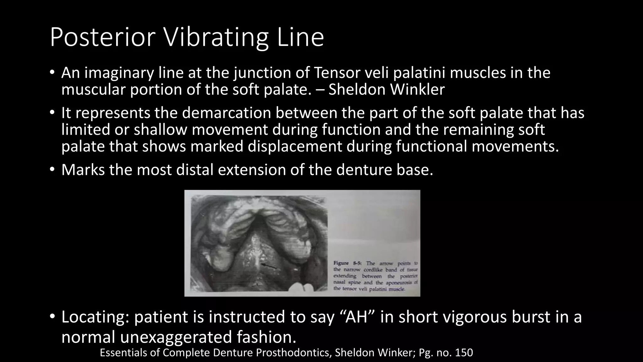 Posterior Palatal Seal | PPTX