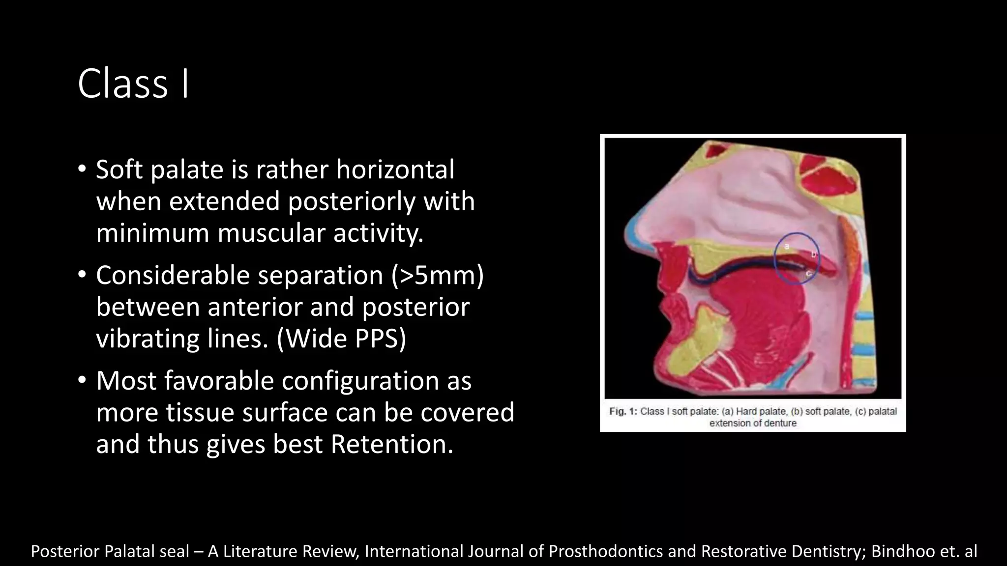 Posterior Palatal Seal | PPTX